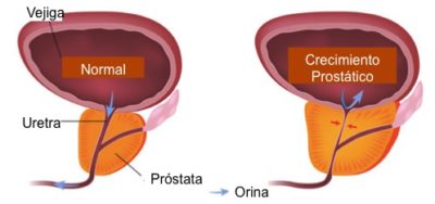 Crecimiento prostático | Dr. Juan Manuel Ochoa López