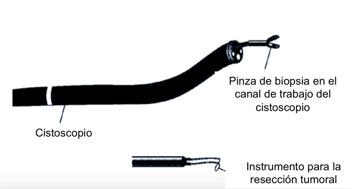 Cistoscopia. Es la visualización directa de la vejiga mediante una ...